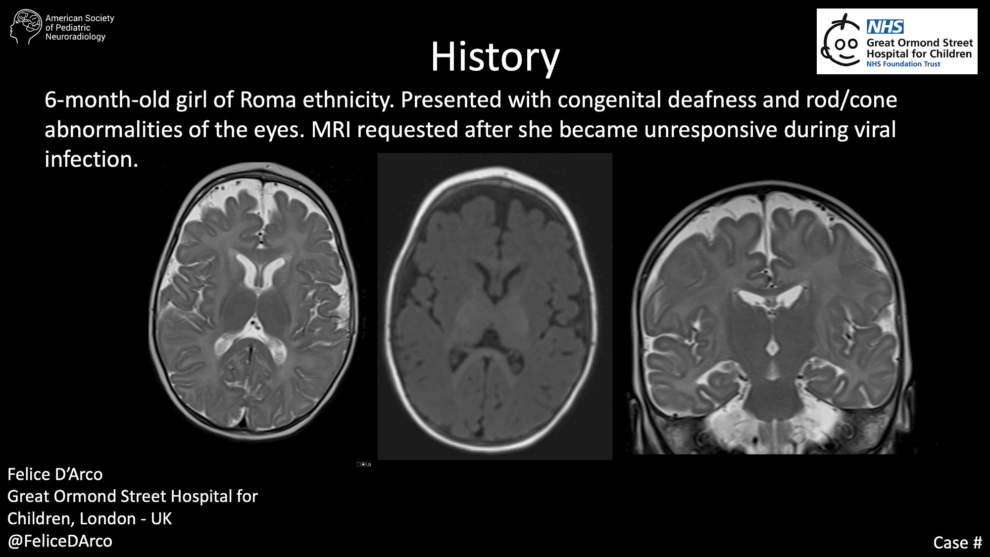 6-month-old girl of Roma ethnicity. Presented with congenital deafness ...