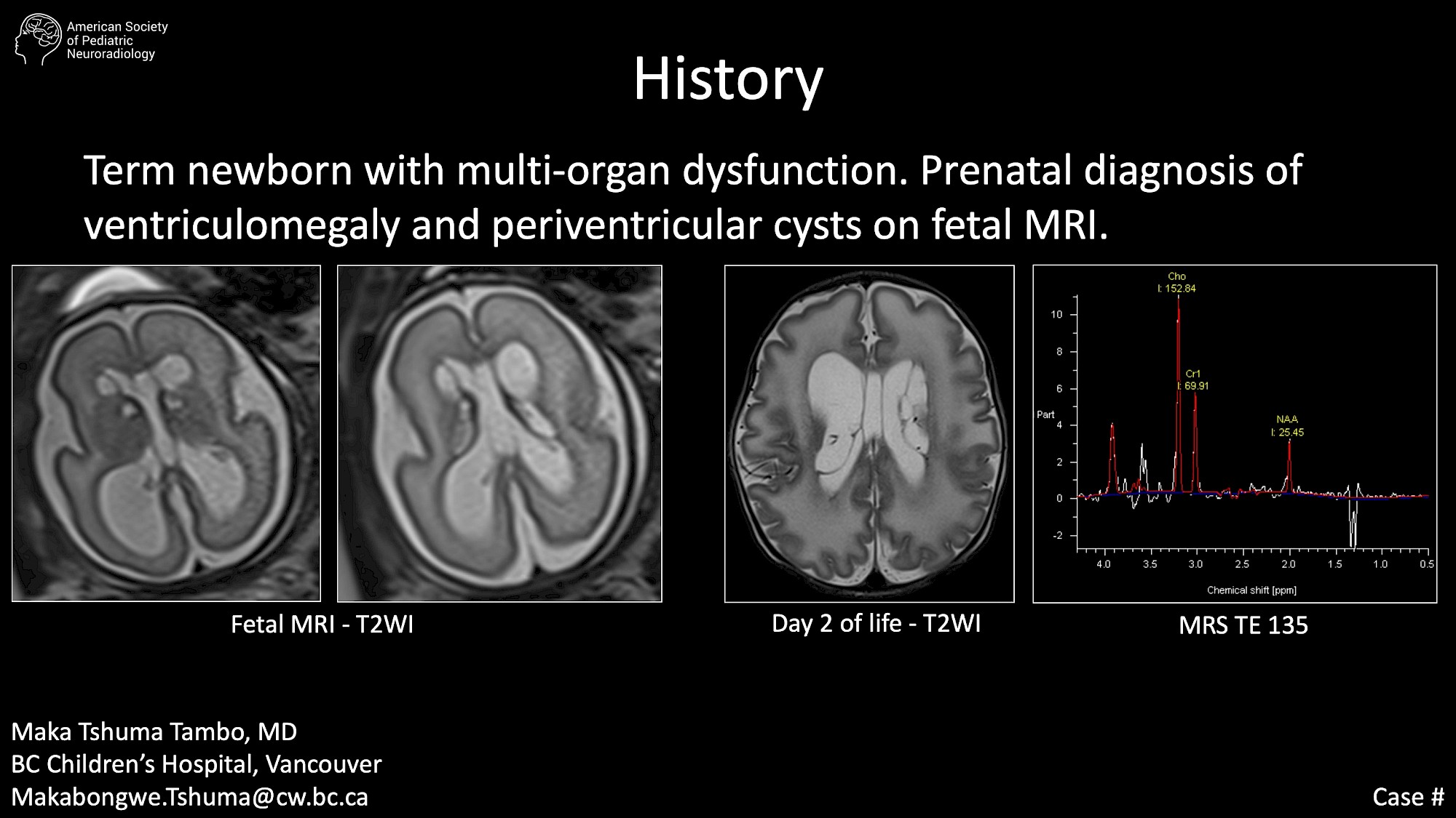 Term newborn with multi-organ dysfunction. Prenatal diagnosis of ...